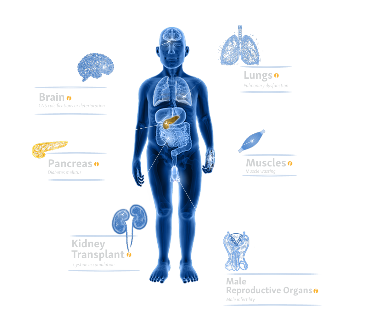 Cystinosis Prognosis and Adherence | For HCPs